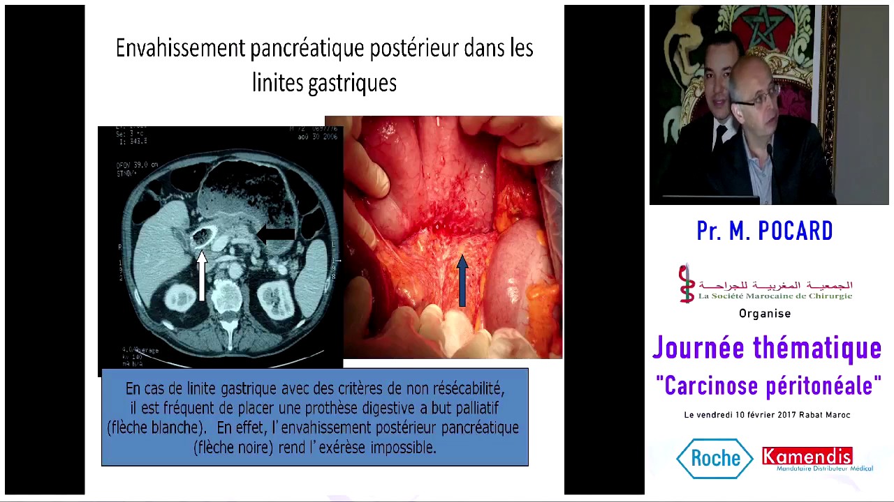 Carcinose péritonéale: le présent et l'avenir. Pr Marc Pocard - YouTube