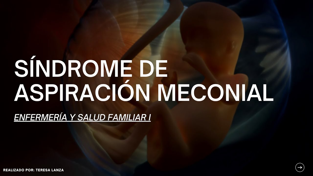 Sindrome de Aspiracion Meconial - YouTube