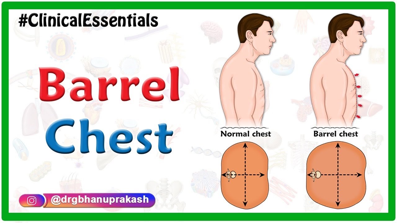 Barrel Chest Clinical Essentials YouTube Barrel Chest Clinical Essentials YouTube