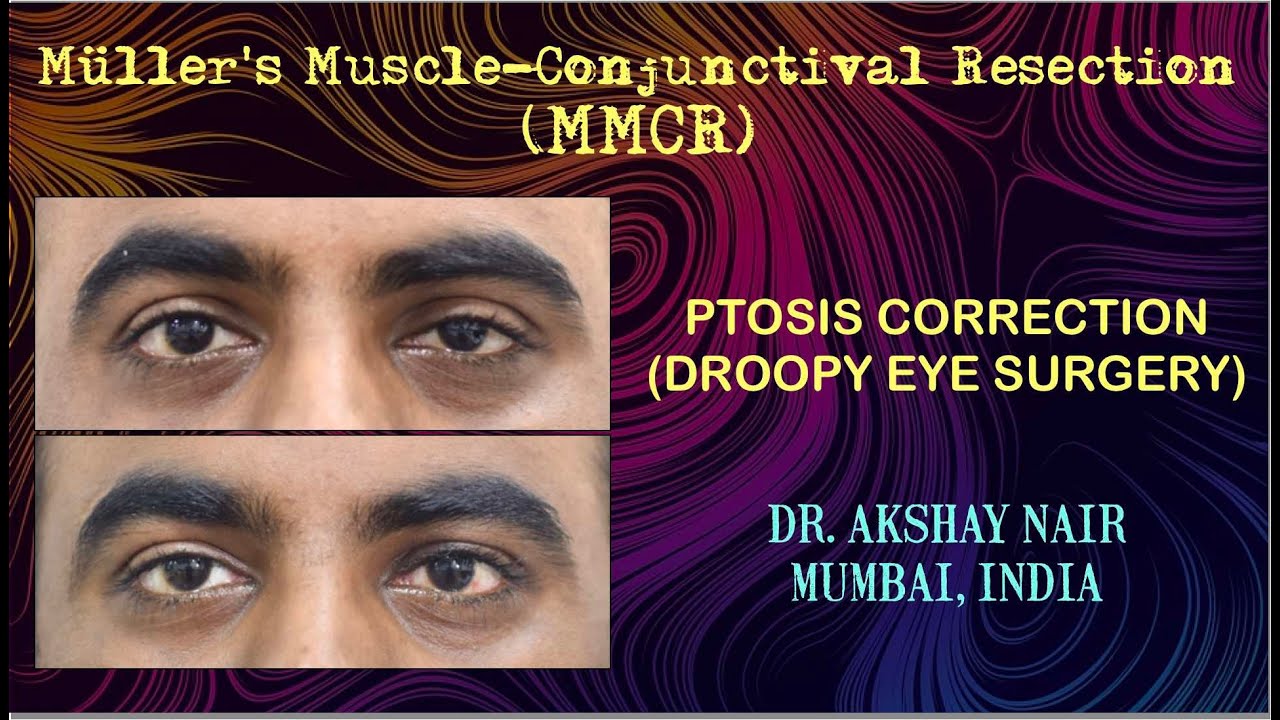 Ptosis Surgery - Müller's muscle-conjunctival resection: Dr Akshay Nair ...
