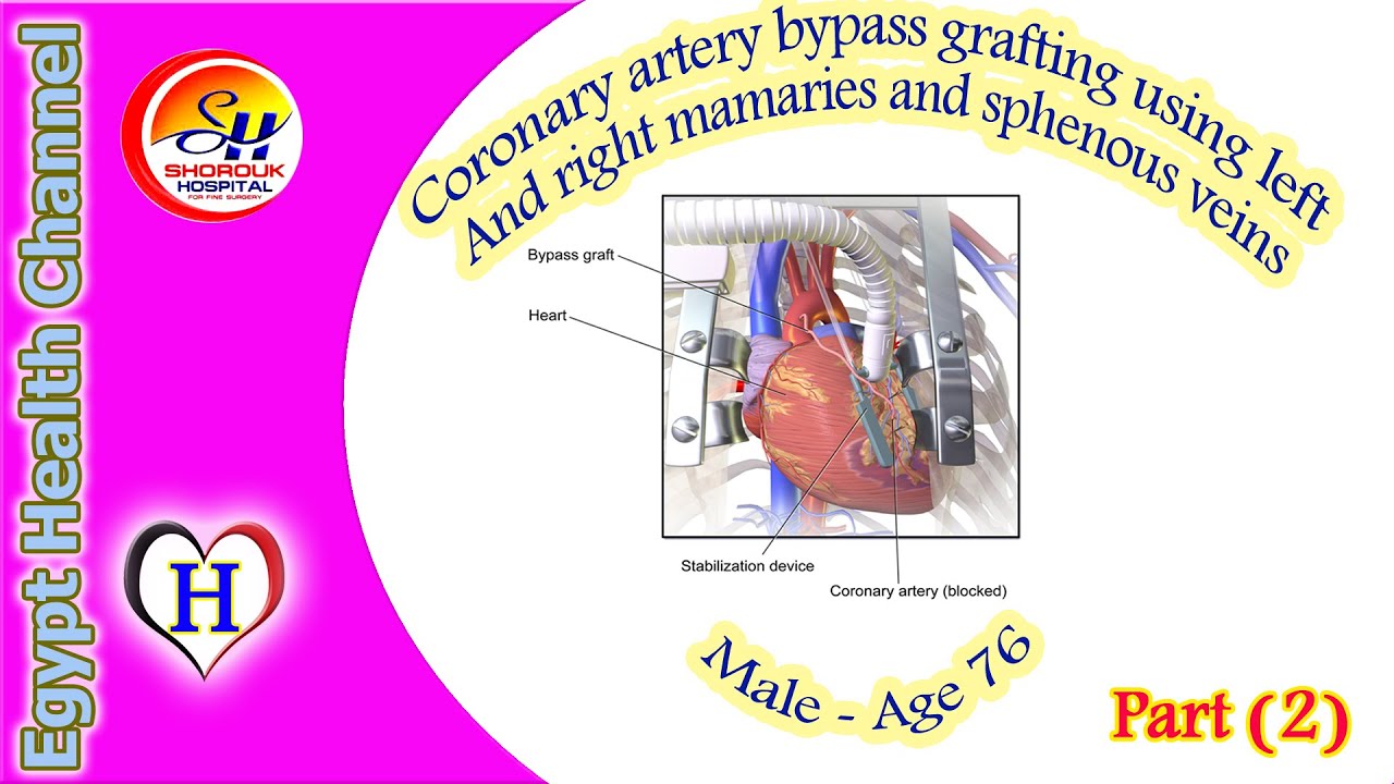Coronary artery bypass grafting using left And right mamaries and ...