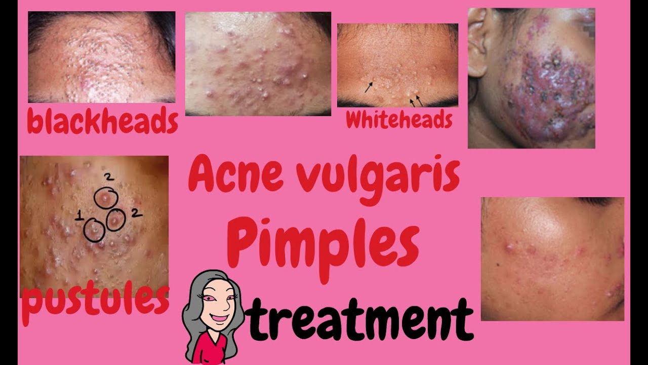 Acne vulgaris or Pimples or Whiteheads, blackheads, papules, and ...