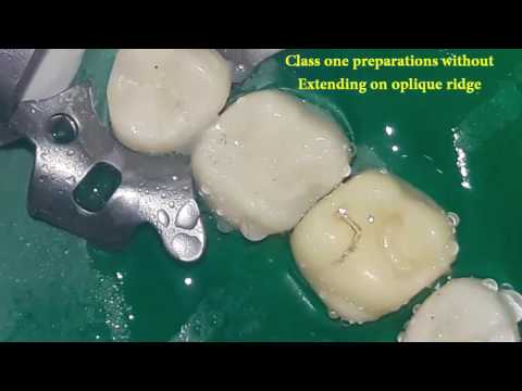 تحضير صنف أول على السن #14 د محمود نعساني Class One Preparation On The ...