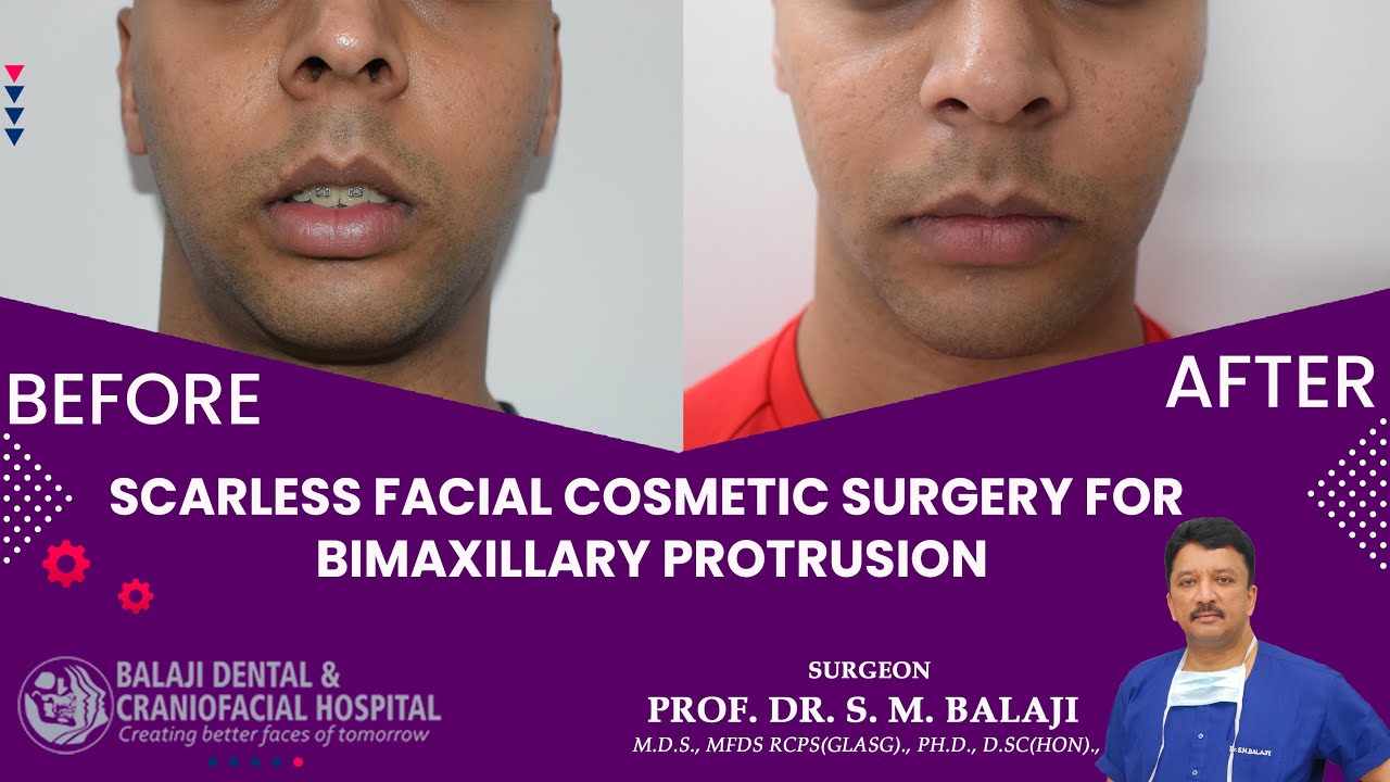 Scarless Facial Cosmetic Surgery for Bimaxillary Protrusion - YouTube