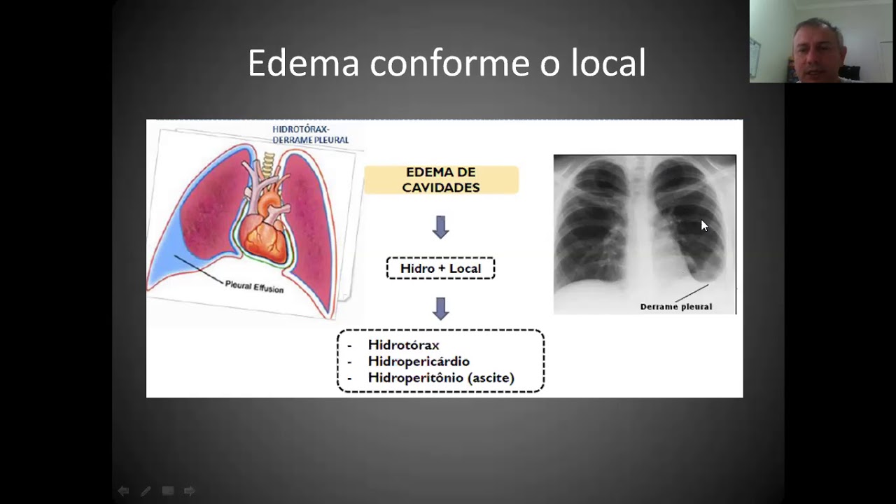 Aula de Biofísica: Pressão e edema (Forças de Starling) - YouTube
