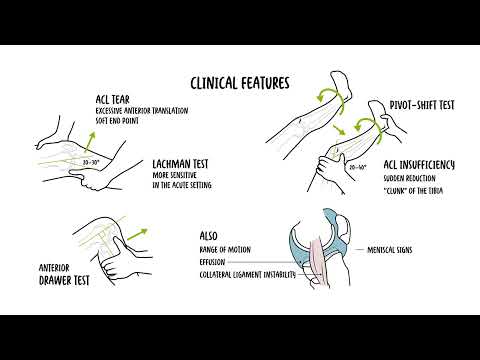 ACL Tear Explained: Causes, Symptoms, Diagnosis and Treatment