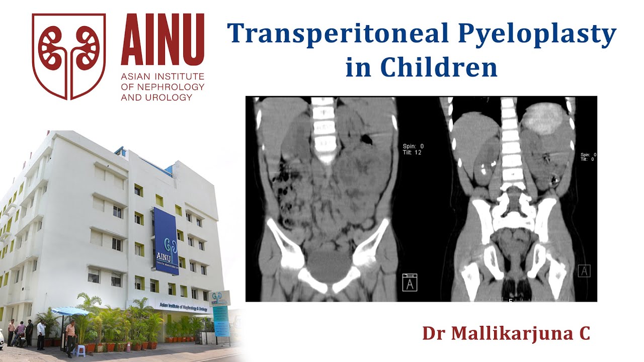 Transperitoneal Pyeloplasty in Children | Surgical Video - YouTube