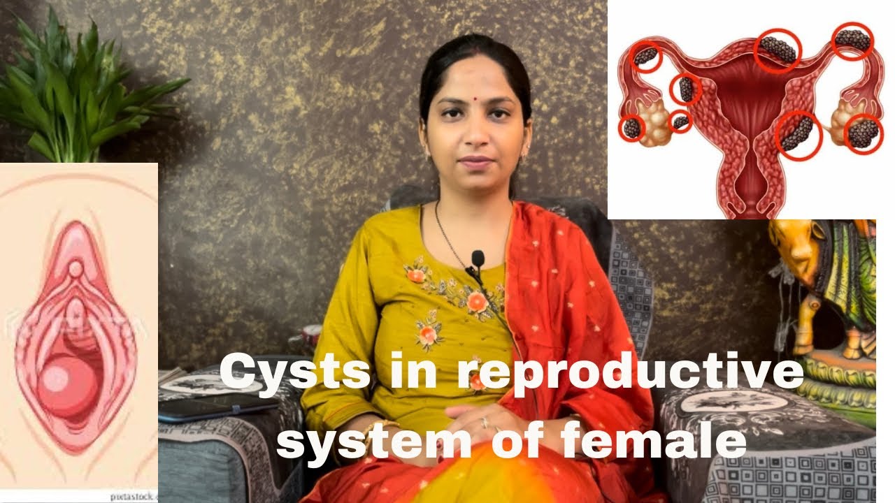 सिस्ट:-गर्भाशय ग्रंथि की बीमारी है !!/cysts in female reproductive ...