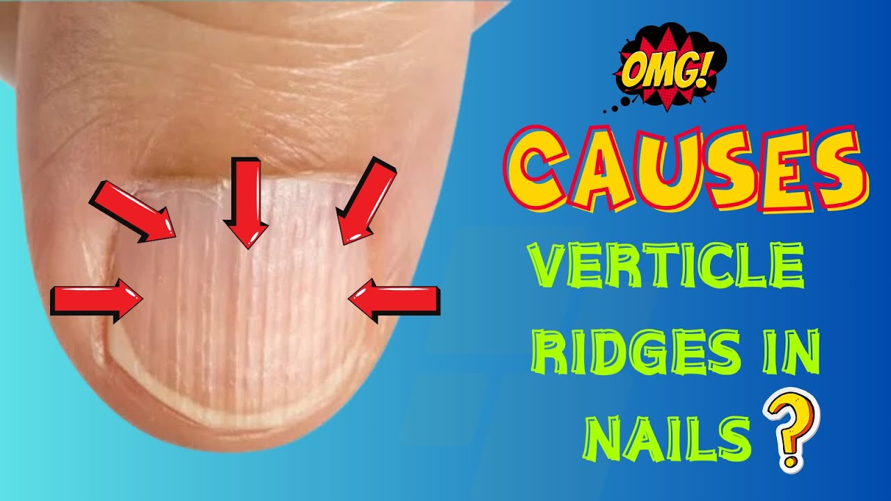 𝗨𝗻𝗹𝗼𝗰𝗸𝗶𝗻𝗴 𝘁𝗵𝗲 𝗠𝘆𝘀𝘁𝗲𝗿𝘆 𝗪𝗵𝗮𝘁 𝗖𝗮𝘂𝘀𝗲𝘀 𝗩𝗲𝗿𝘁𝗶𝗰𝗮𝗹 𝗡𝗮𝗶𝗹 𝗥𝗶𝗱𝗴𝗲𝘀? 𝗡𝗮𝗶𝗹 𝗛𝗲𝗮𝗹𝘁𝗵 ...