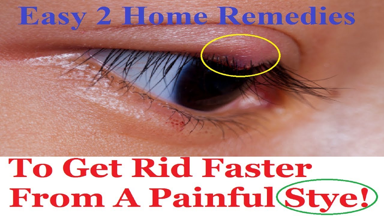 How To Get Rid Of A Stye ¦¦ Quick And Easy 2 Home Remedies - YouTube