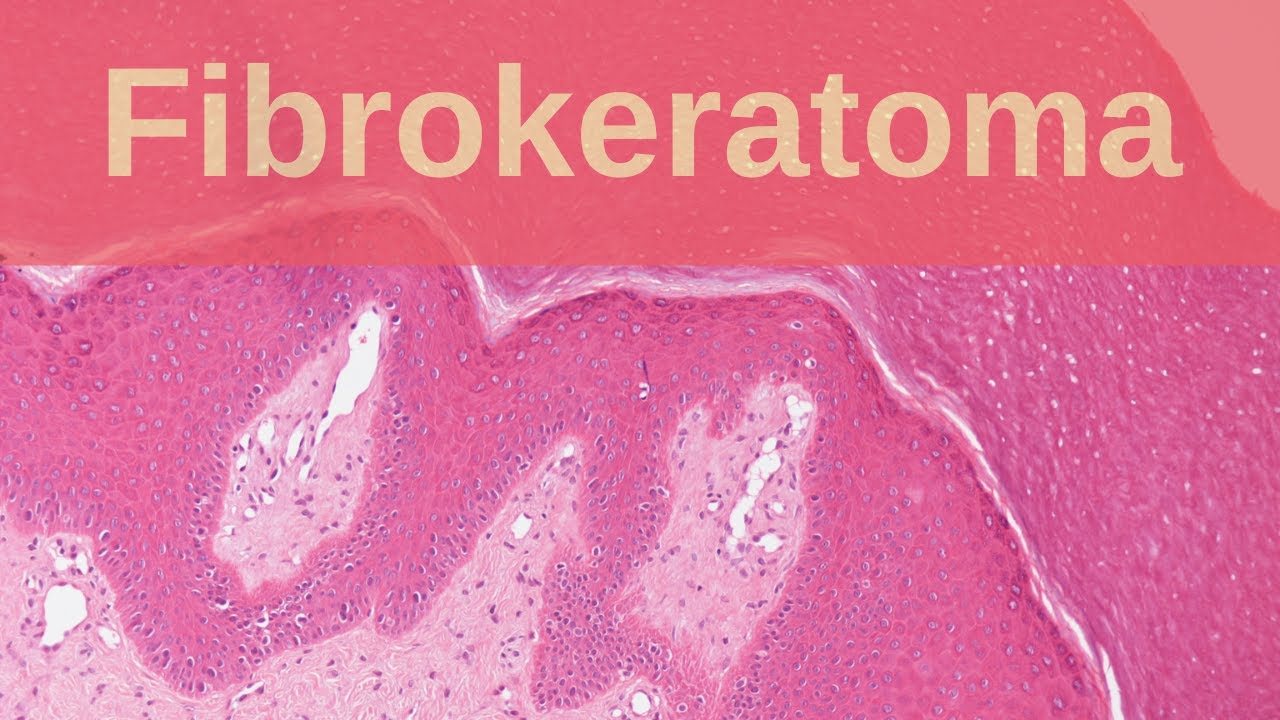 Acquired Digital Fibrokeratoma - Pathology mini tutorial - YouTube