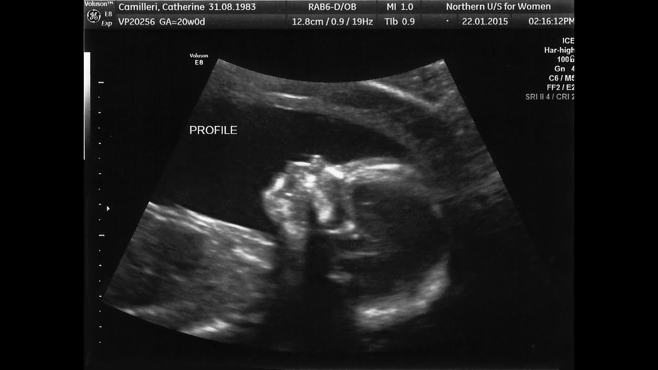 20 Week Scan - YouTube