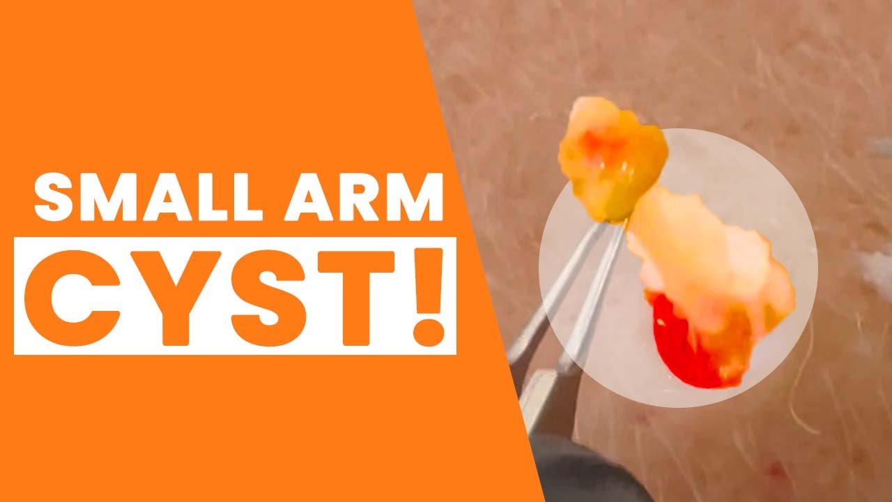 SMALL ARM CYST! - YouTube