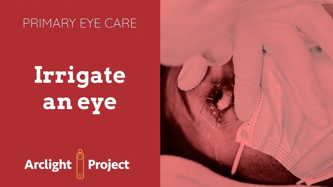 How to irrigate an eye: Arclight Project, WHO Primary Eye Care - YouTube