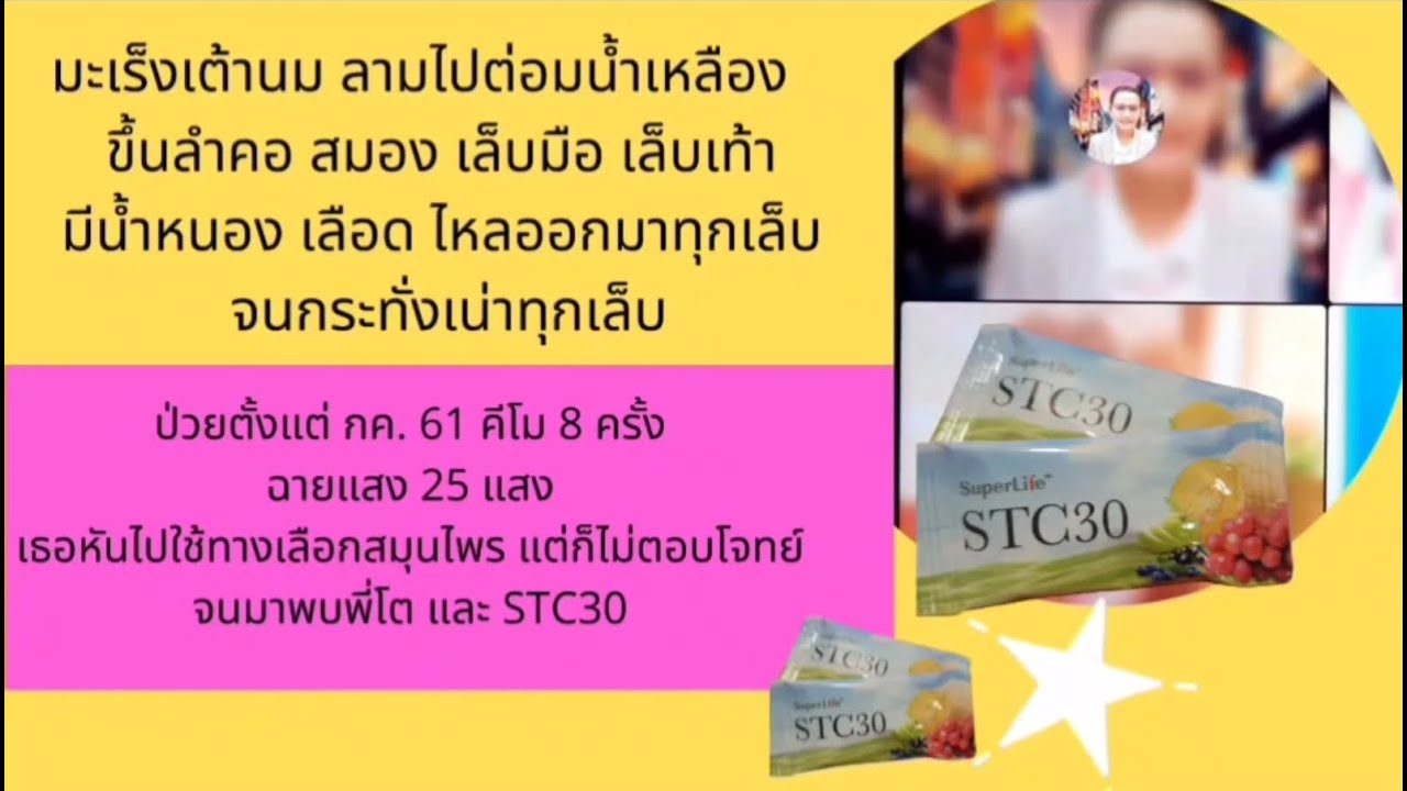 stc 30 มะเร็งเต้านม ลามไปต่อมน้ำเหลือง - YouTube