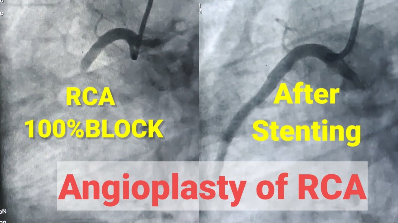 Primary Angioplasty of RCA, Stenting of RCA, 100% blcoked RCA - YouTube