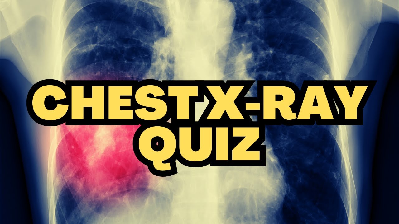 Chest X-ray Quiz - YouTube