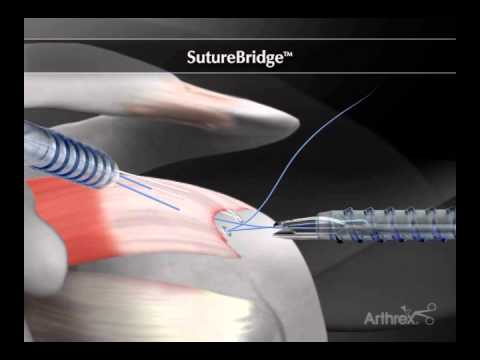SutureBridge DoubleRow - YouTube