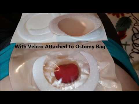 Stoma Guard No Belt Stoma Dome 10-28-16 - YouTube