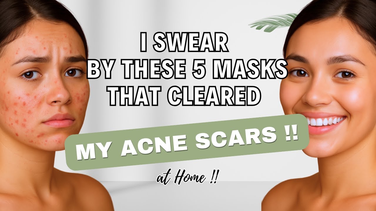5 DIY Face Masks to Fade Acne Scars Clear Hyperpigmentation Even Skin ...