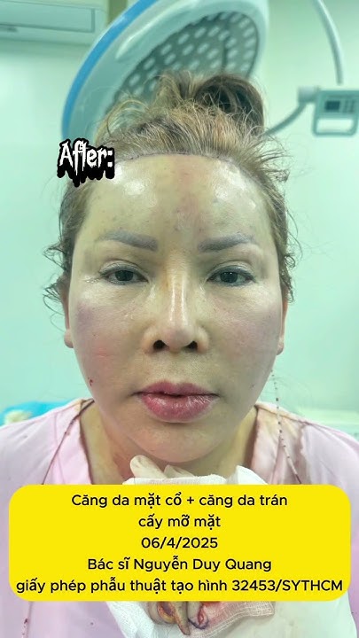 căng da mặt cổ trán bác sĩ Nguyen Duy Quang - YouTube