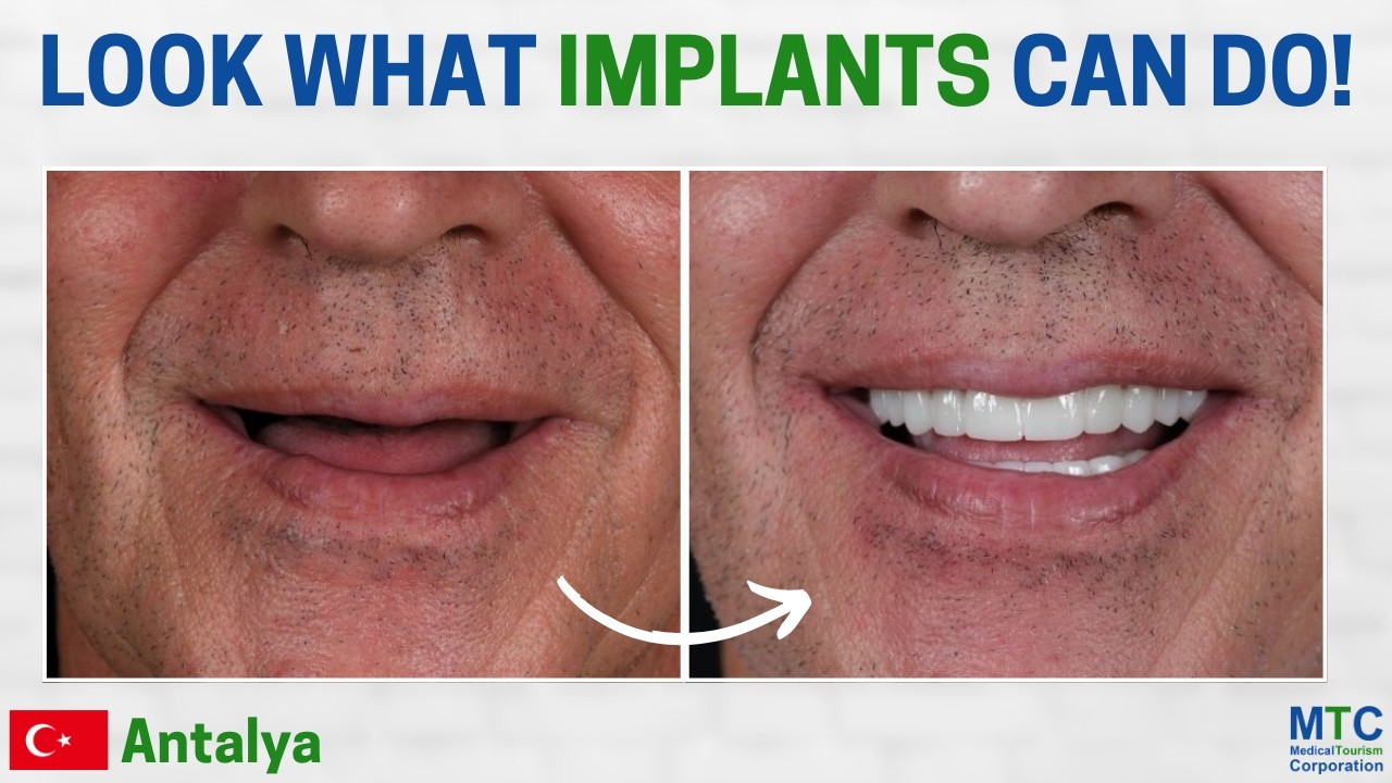 Dental Implants in Antalya: The Complete Guide to a Smile Makeover in ...