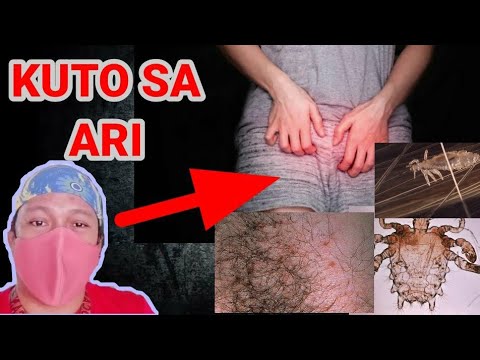 PAANO MAIIWASAN ANG KUTO SA ARI /TIPS AT SINTOMAS - YouTube