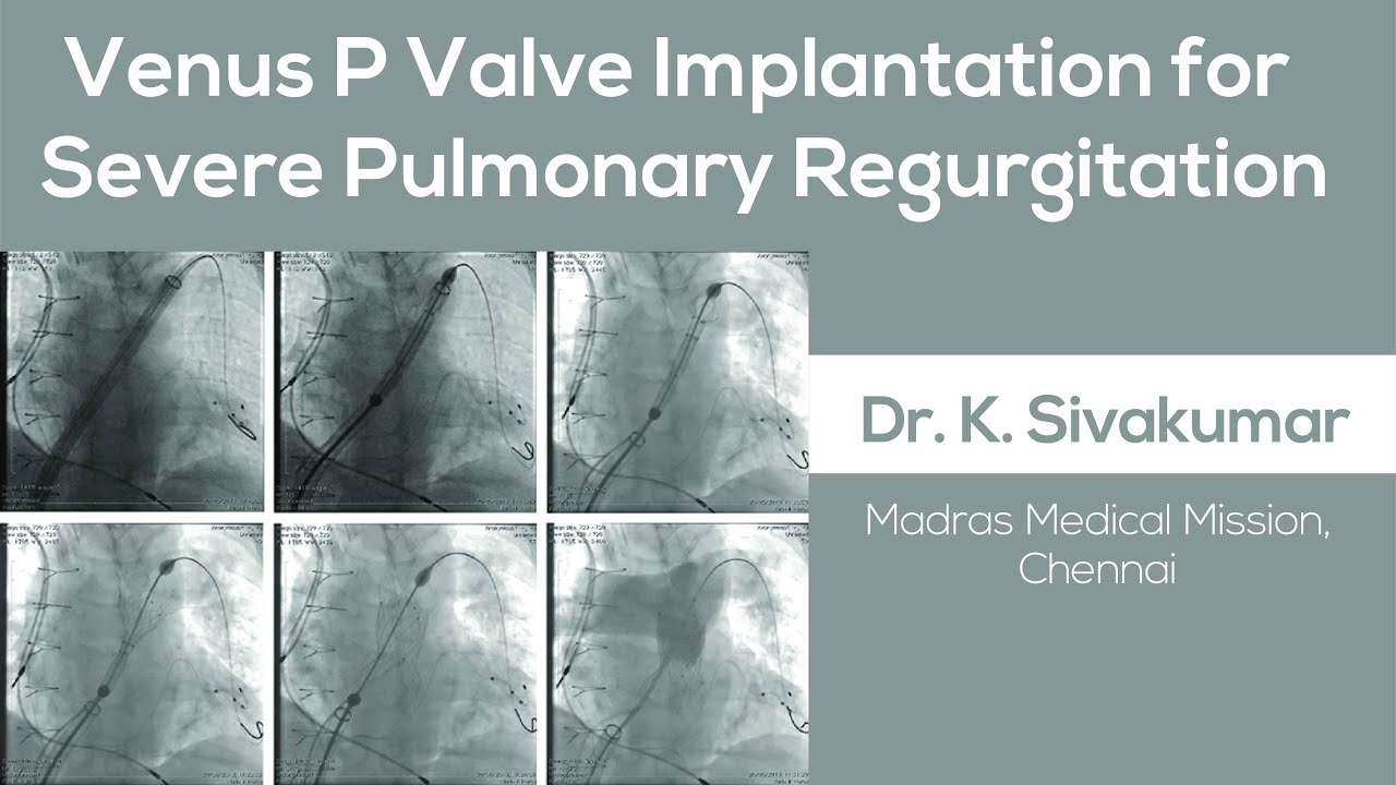 Venus P Valve Implantation for Severe Pulmonary Regurgitation - YouTube