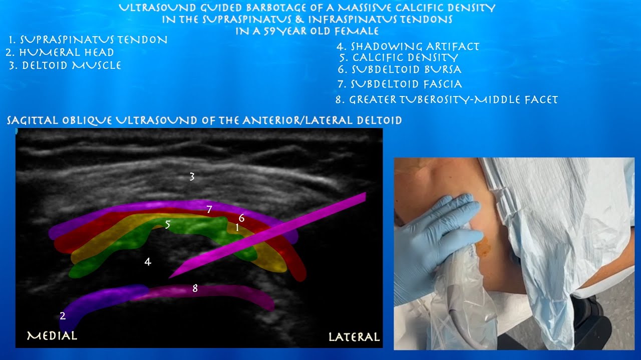 Ultrasound Guided Barbotage of Massive Calcific Tendinitis ...