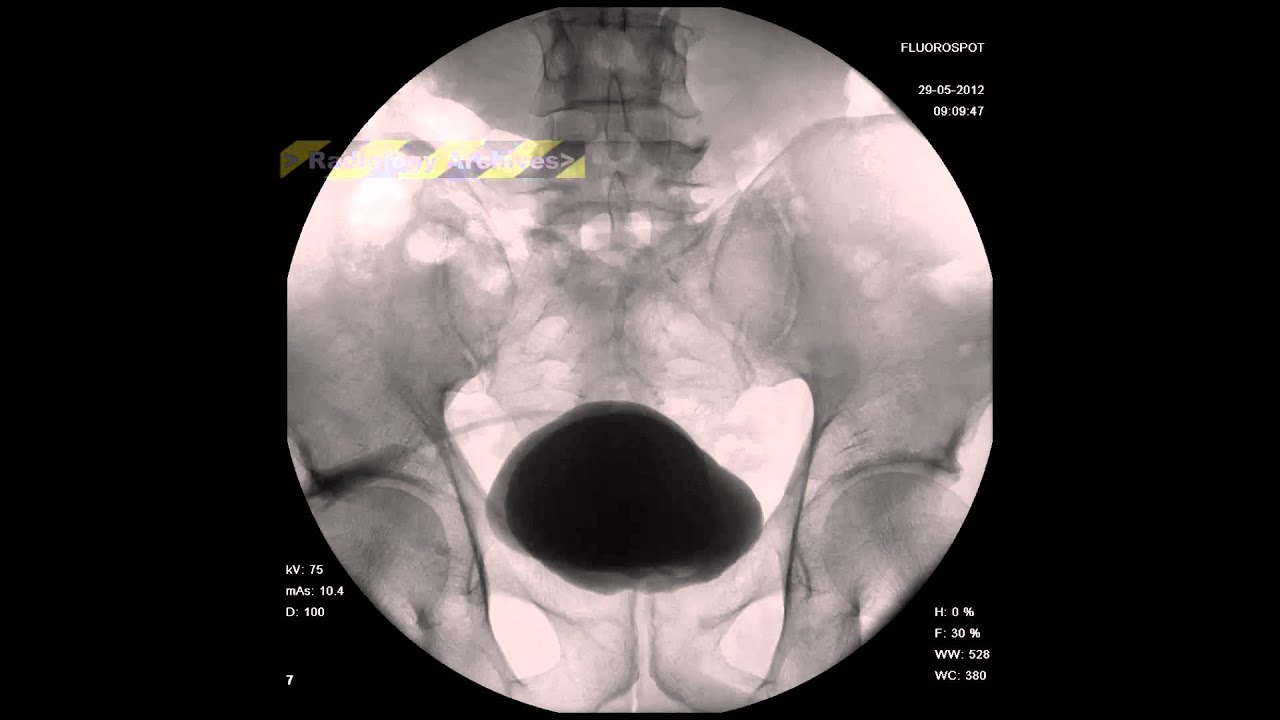 Κατιούσα Κυστεοουρηθρογραφία Voiding Cystourethrogram - YouTube