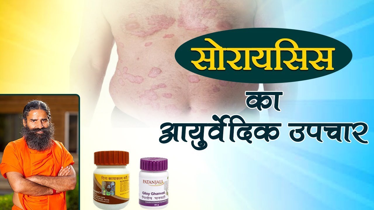 सोरायसिस का आयुर्वेदिक उपचार | Swami Ramdev - YouTube
