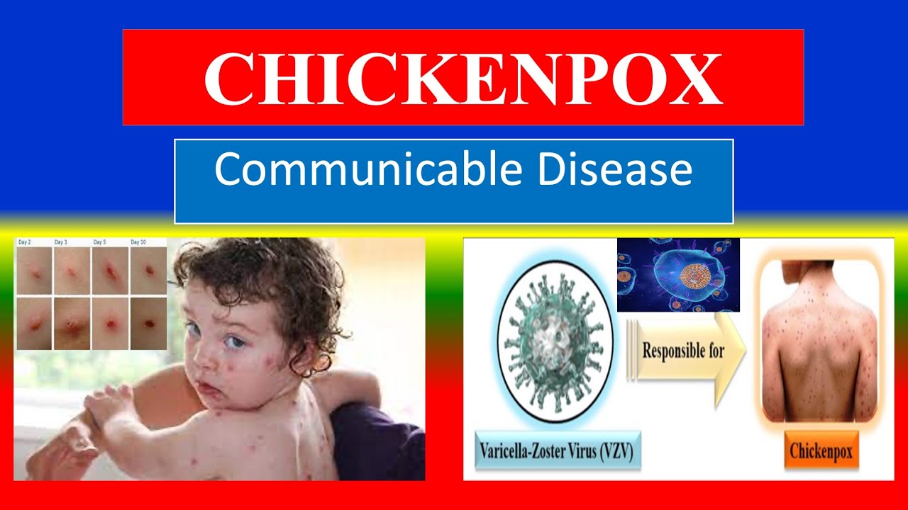 CHICKENPOX - Definition , types , cusses , Pathophysiology , signs ...