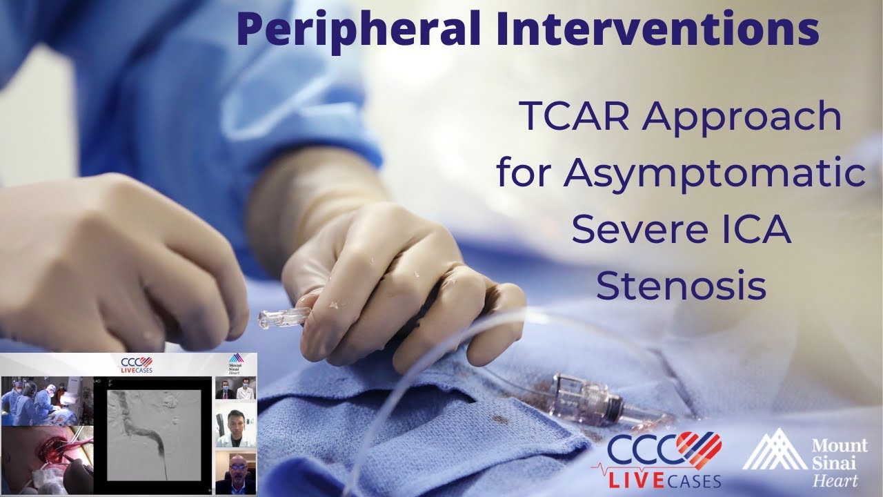TCAR Approach for Asymptomatic Severe ICA Stenosis – Peripheral March 2021 - YouTube