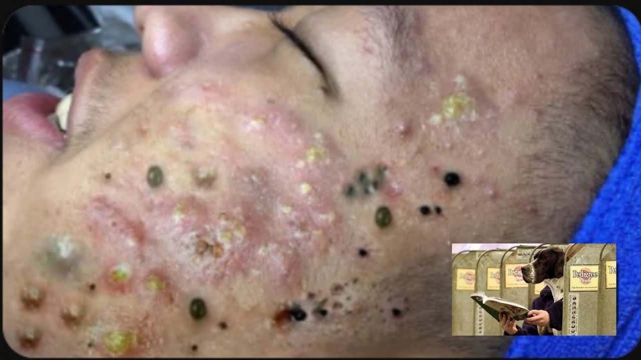 Satisfying blackhead remove and relaxation pimple popping - YouTube