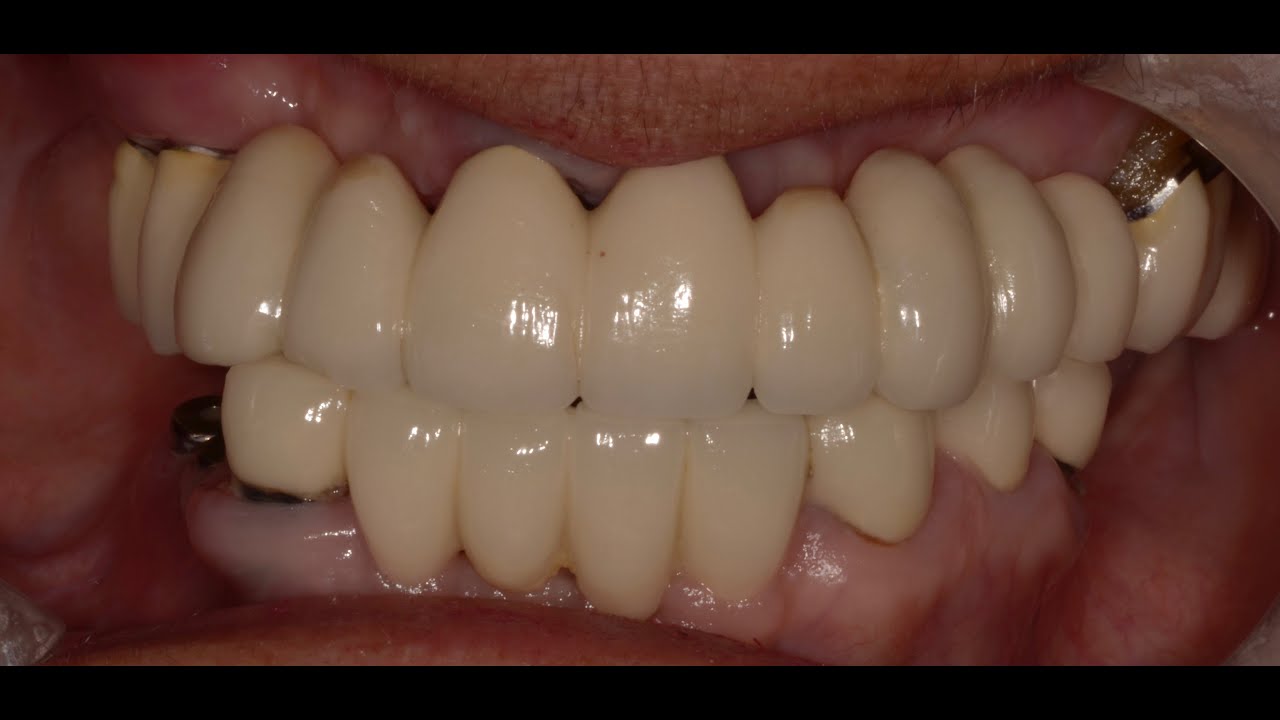 Upper Dental Bridge-Good or Bad?. Find Out - YouTube