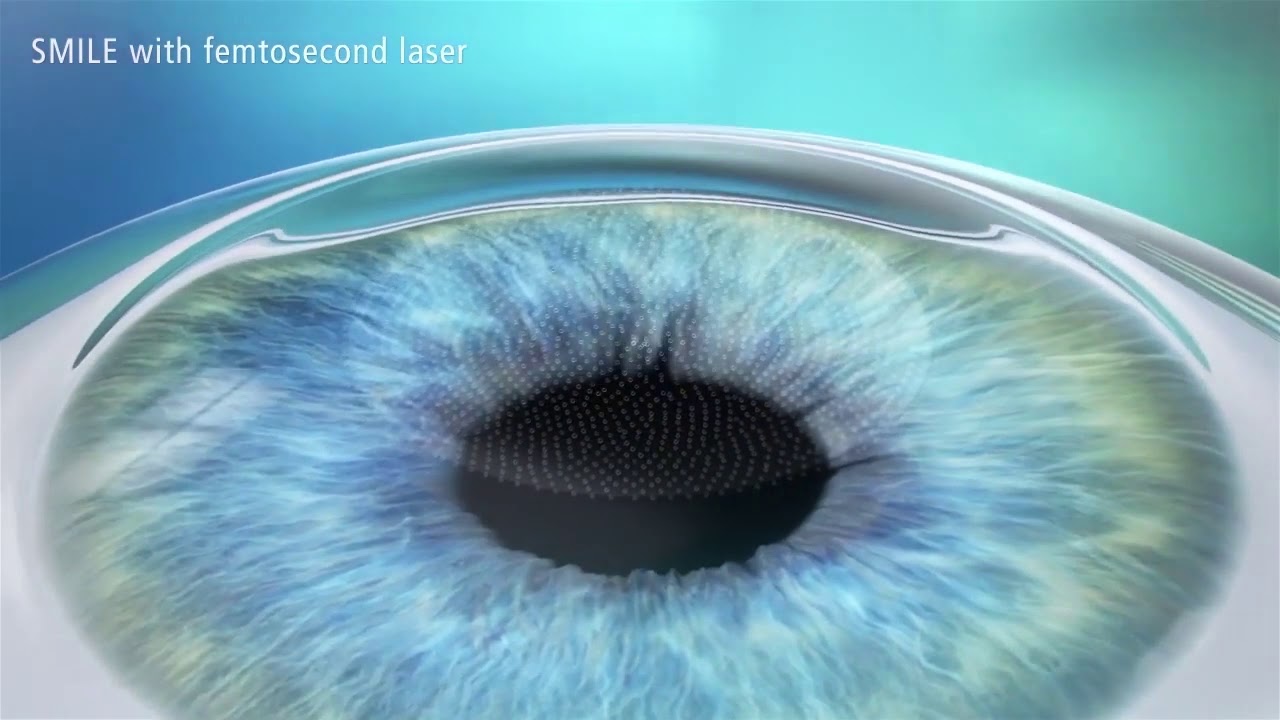 SMILE Eye Surgery in Delhi at The Sight Avenue - YouTube
