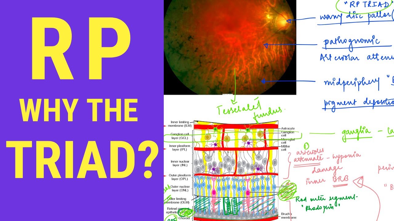 Retinitis Pigmentosa - WHY the triad? - YouTube