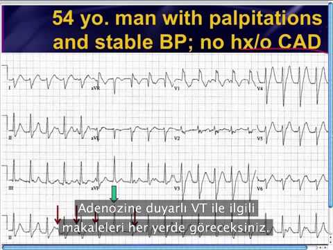 Amal Mattu'nun Haftalık EKG Vakası: VT Bölüm II - Adenozin - 2 Eylül ...