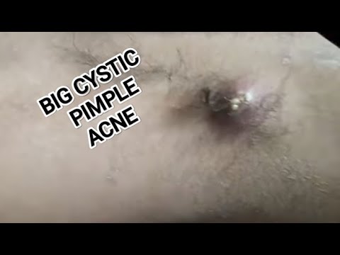 💥SATISFYING CYSTIC ACNE CYSTIC PIMPLE. SOME INFORMATIONS. - YouTube