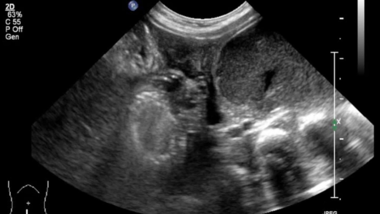 PED Hydrometrocolpos - YouTube