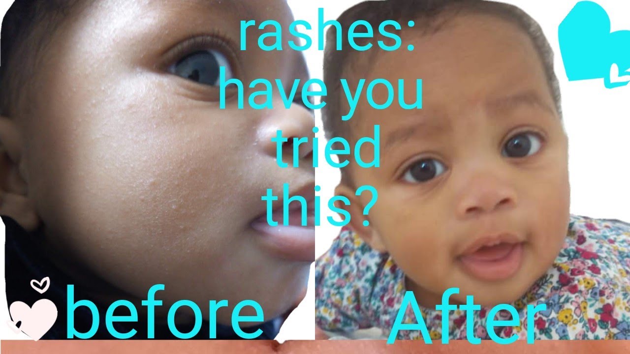 How I got rid of my baby's rashes |tips on how to protect your new born ...