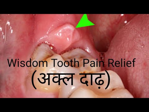 AKAL DAAD PAIN(अक्ल दाढ़) HOME REMEDIES | Wisdom Tooth pain - YouTube