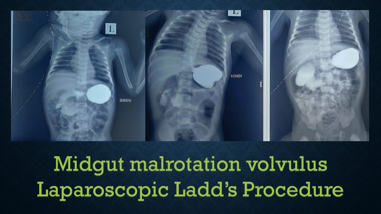 Laparoscopic Ladd's procedure in a neonate for midgut volvulus - YouTube