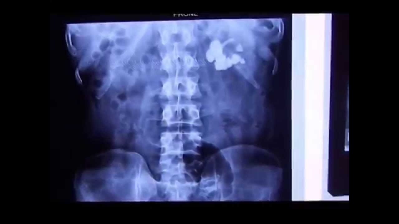 Intravenous Pyelogram Or Nephrogram Ivp In Staghorn Calculus Youtube