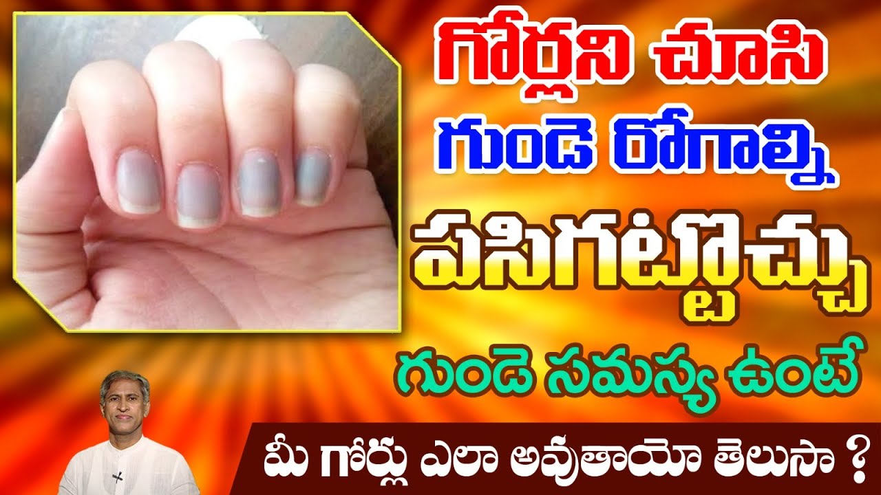 How do Nails warn About Your Health? | Nail Diseases | Anemia Symptoms ...