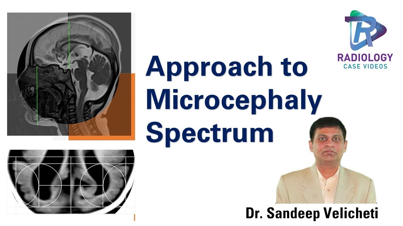 Approach to microcephaly spectrum#CT and MRI Microcephaly - YouTube