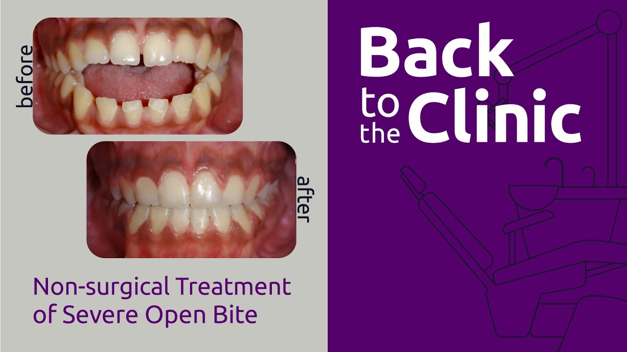 Non-surgical Treatment of Severe Open Bite - Back to the Clinic #004 ...