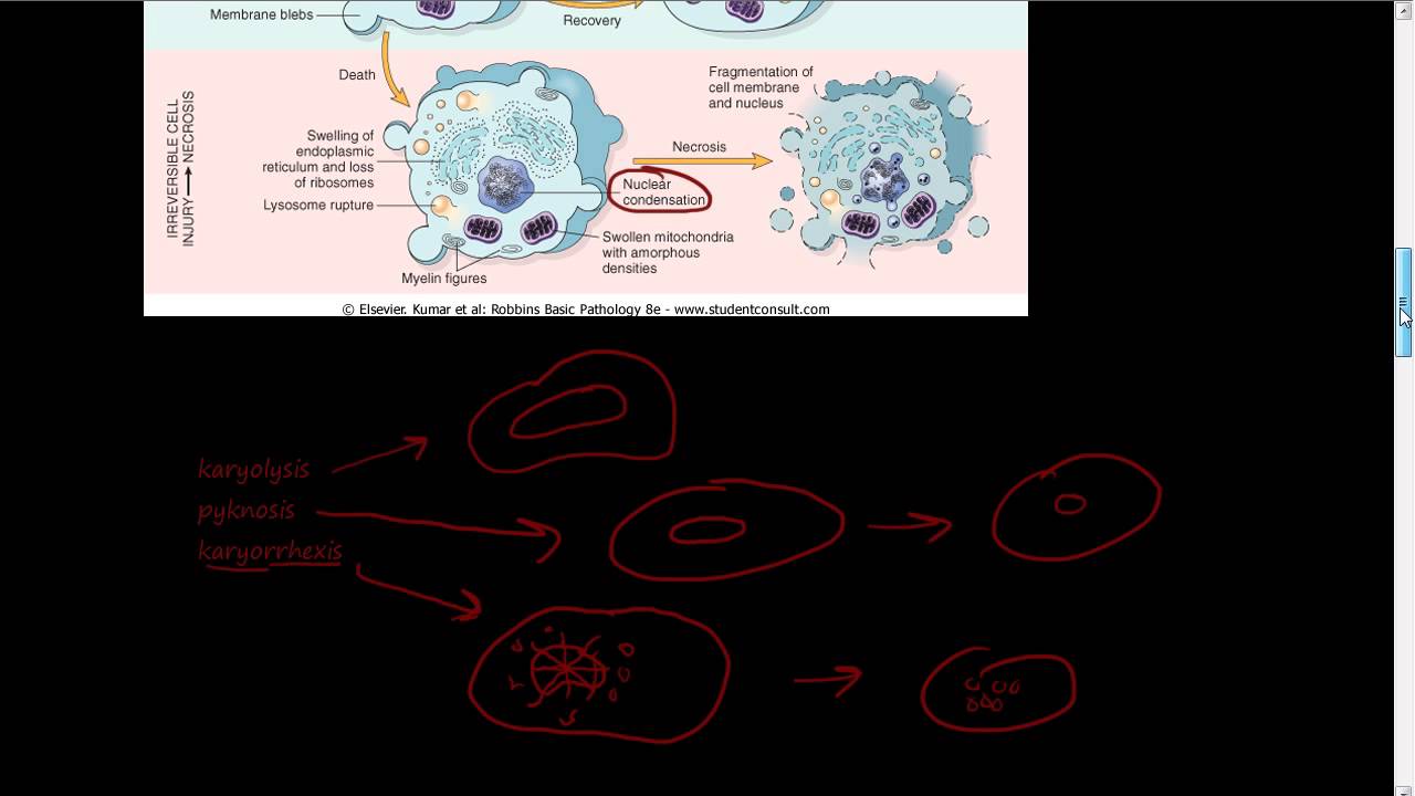 #8 - Micro and Macro morphology of necrosis - karyolysis, pyknosis ...