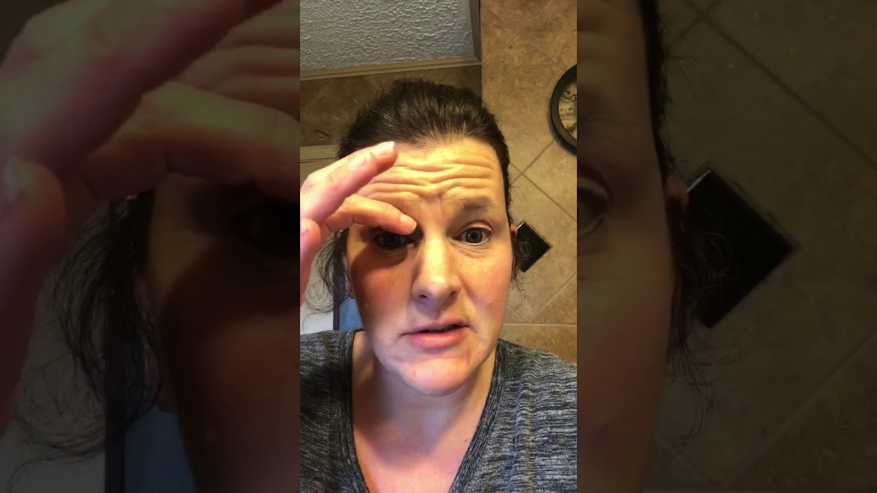 Post-Op Day 2/Implants Uncovered/Healing Caps On - YouTube