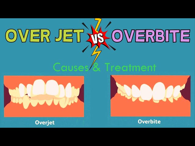 Overjet Vs Overbite